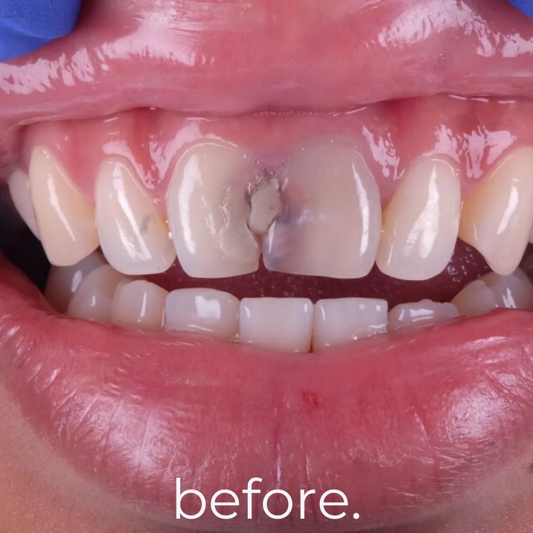 Dental Crowns - Fidelity Dental Bali