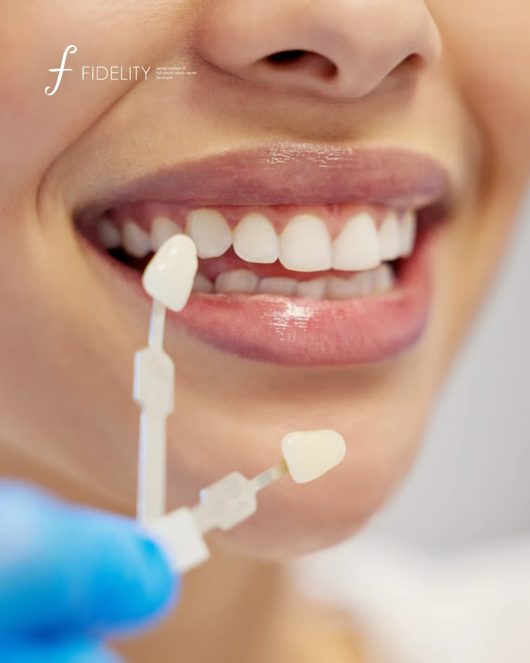 Veneers vs. Composite: Which Is Better? - Fidelity Dental Bali